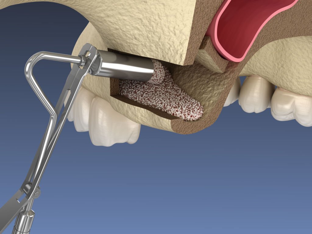 Dental Bone Graft Vs Sinus Lift at Joseph Park blog