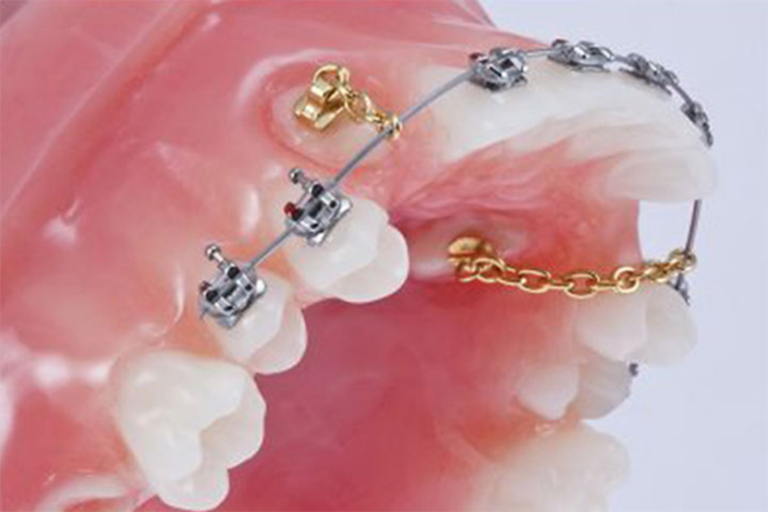 Pre Orthodontic Surgical Treatment - Appledore Dental & Implant Centre