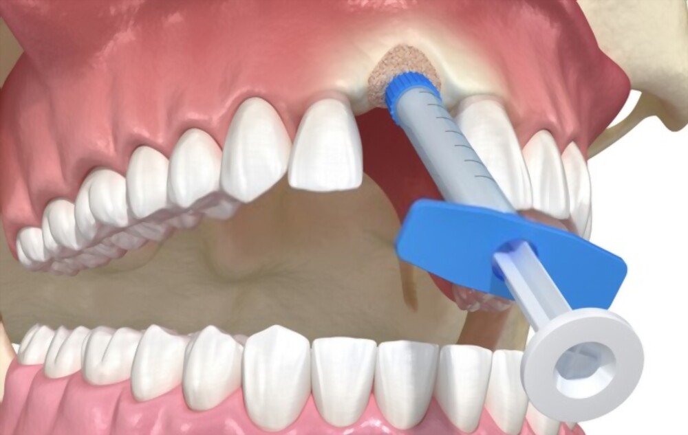 Socket Preservation - Appledore Dental & Implant Centre